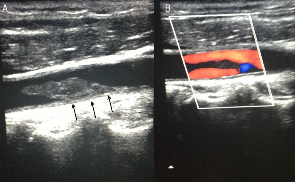 Vascular Ultrasound | Dr. Glossy Sabharwal